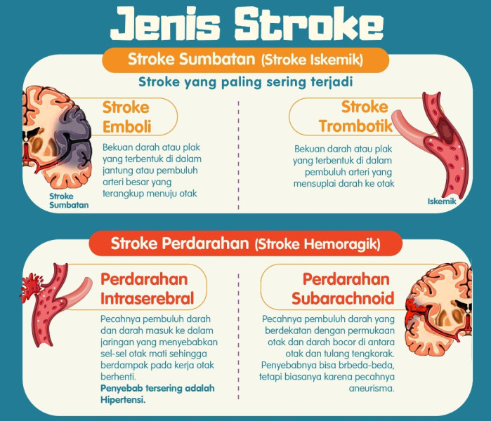 Dinkes Inhil: Yuk Kita Mengenal Lebih Dekat Tentang Penyakit Stroke ...